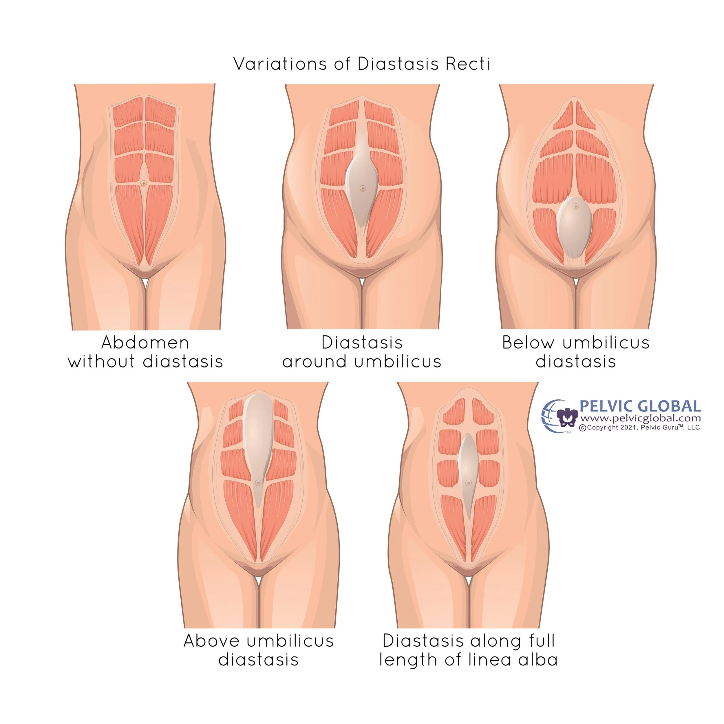 Effective Diastasis Recti Recovery Causes and Treatments