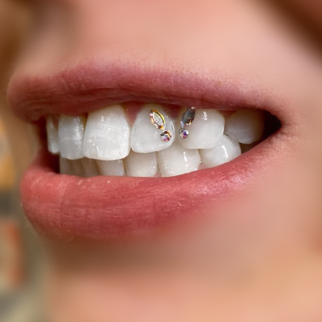 Teeth Whitening & Tooth Gem Refresher Training Courses — ILLUMINATE ...