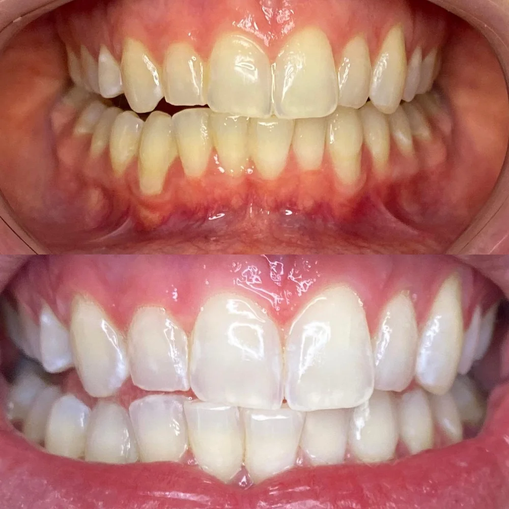 Self-Study Teeth Whitening Training & Certification Course — ILLUMINATE ...