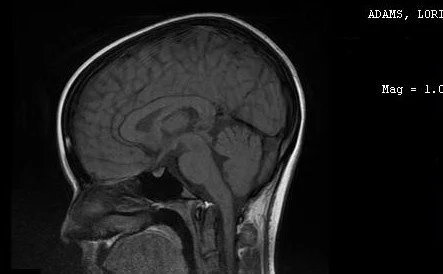 The Keyhole Craniotomy — Spoonful