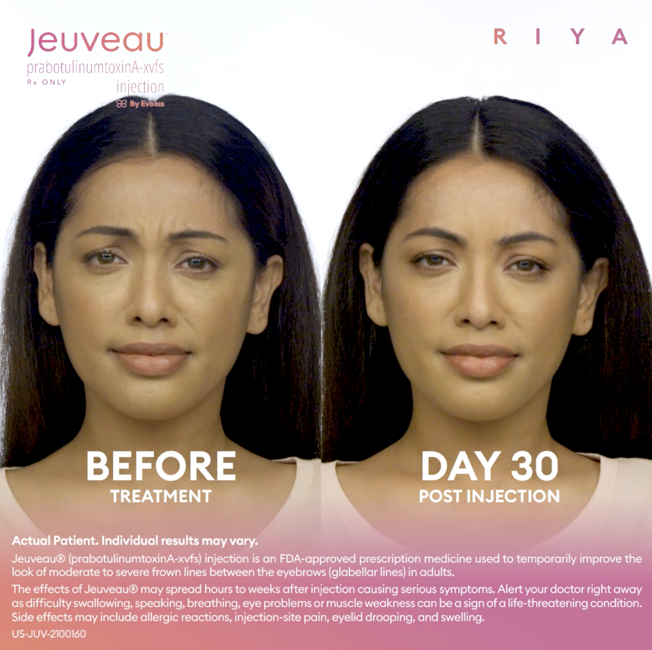 Injectables | Botox in Arkansas — Northwest Arkansas Center for Plastic ...