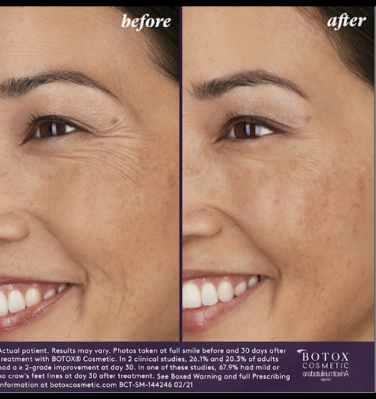 Injectables | Botox in Arkansas — Northwest Arkansas Center for Plastic ...