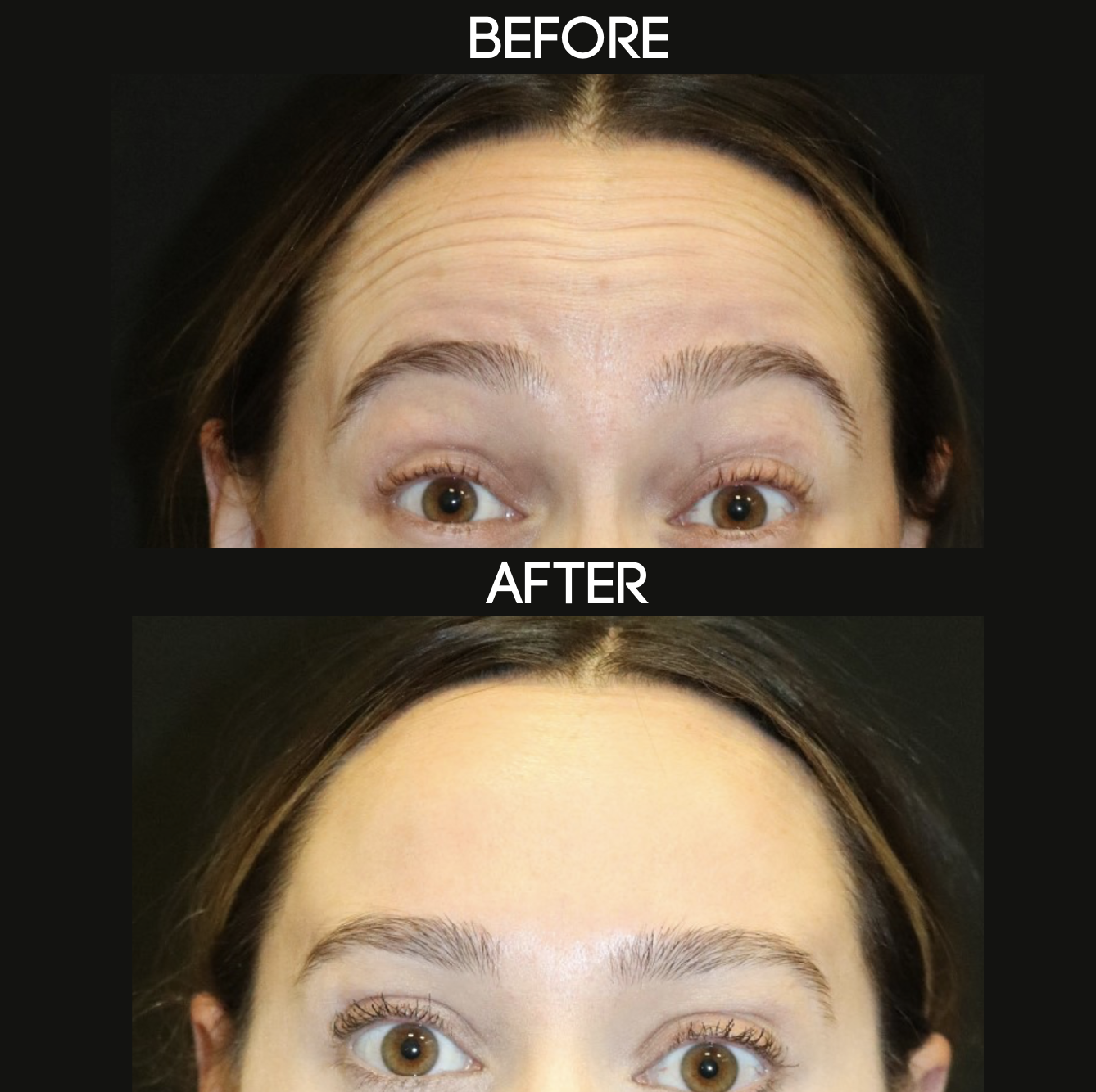 Injectables | Botox in Arkansas — Northwest Arkansas Center for Plastic ...