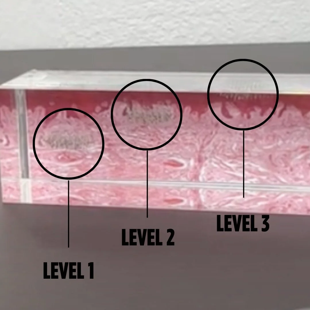Results — LASEROPTEK