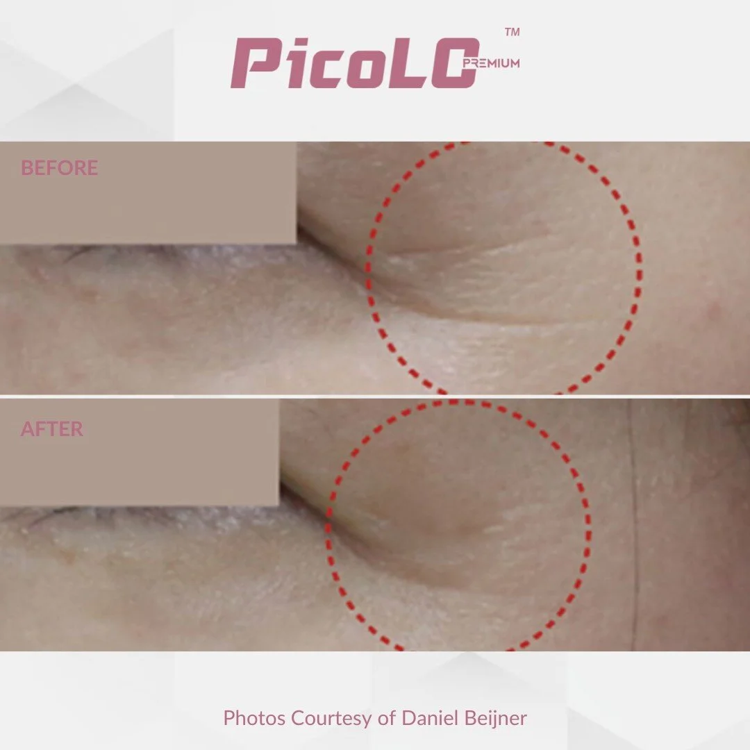 About — LASEROPTEK