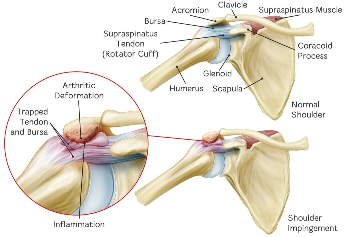 Understanding Anterior Shoulder Pain: Biceps Tendonitis vs. Shoulder ...