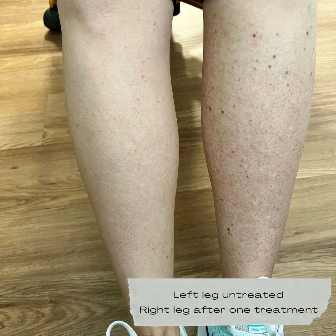 Lumecca IPL Laser Treatments — Amplify Aesthetics