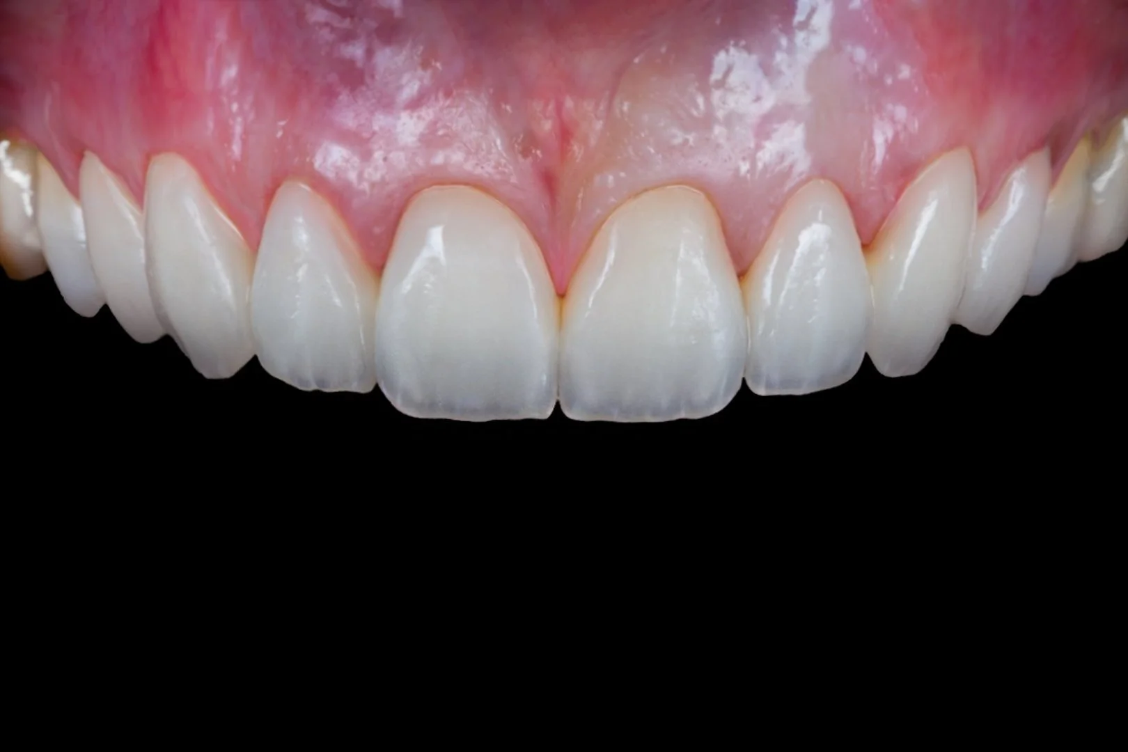 Neuromuscular Dental Lab | VeneerLab Dental Aesthetics