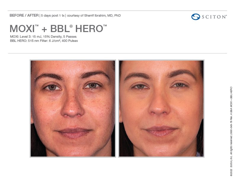 Moxi Laser — Bloom Skin Aesthetics