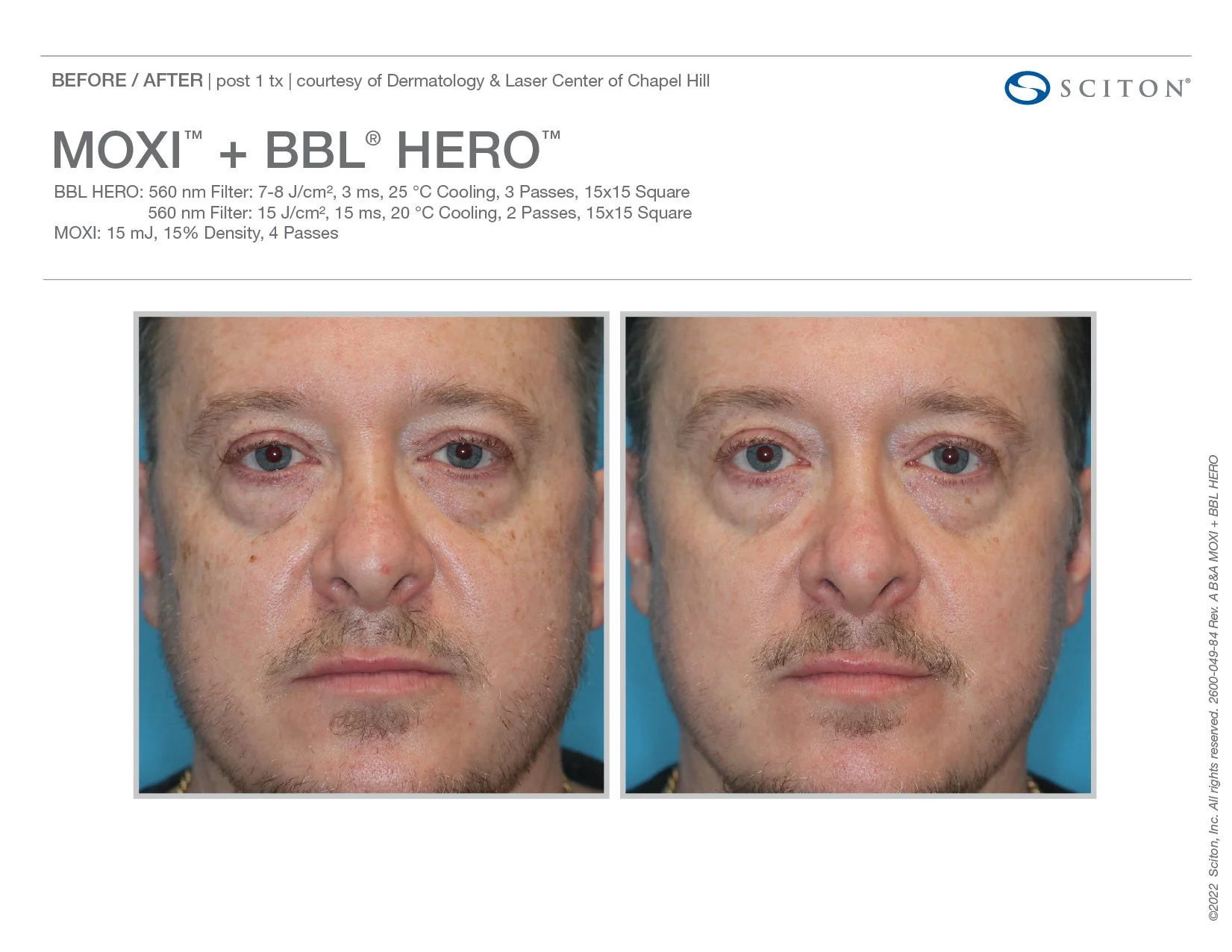 Moxi Laser — Bloom Skin Aesthetics