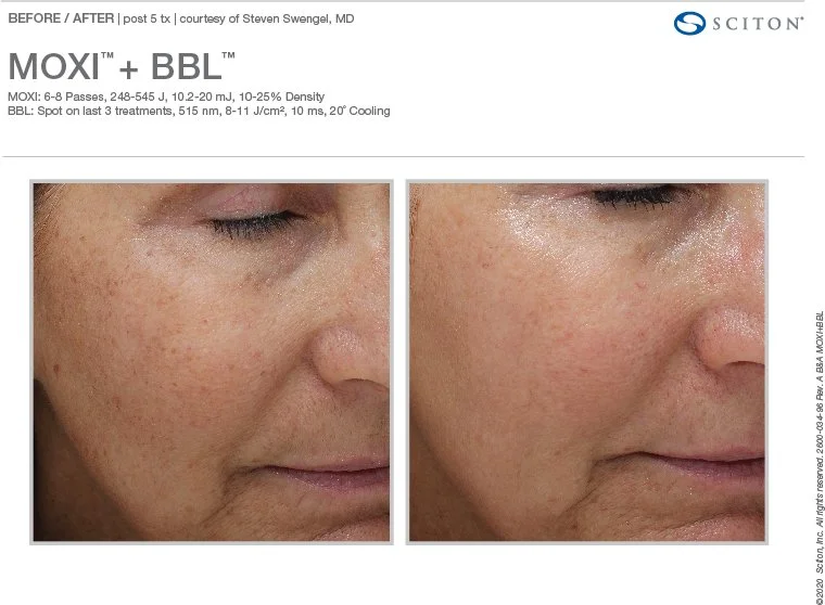 Moxi Laser — Bloom Skin Aesthetics