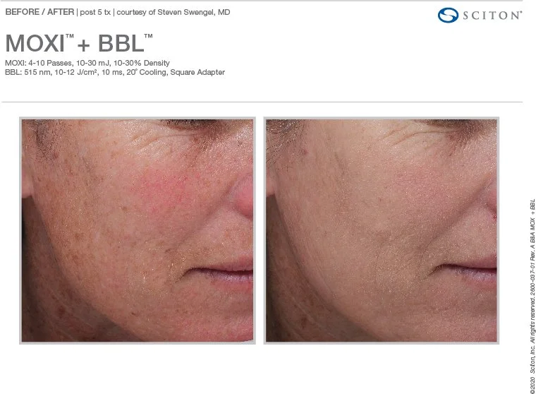 Moxi Laser — Bloom Skin Aesthetics