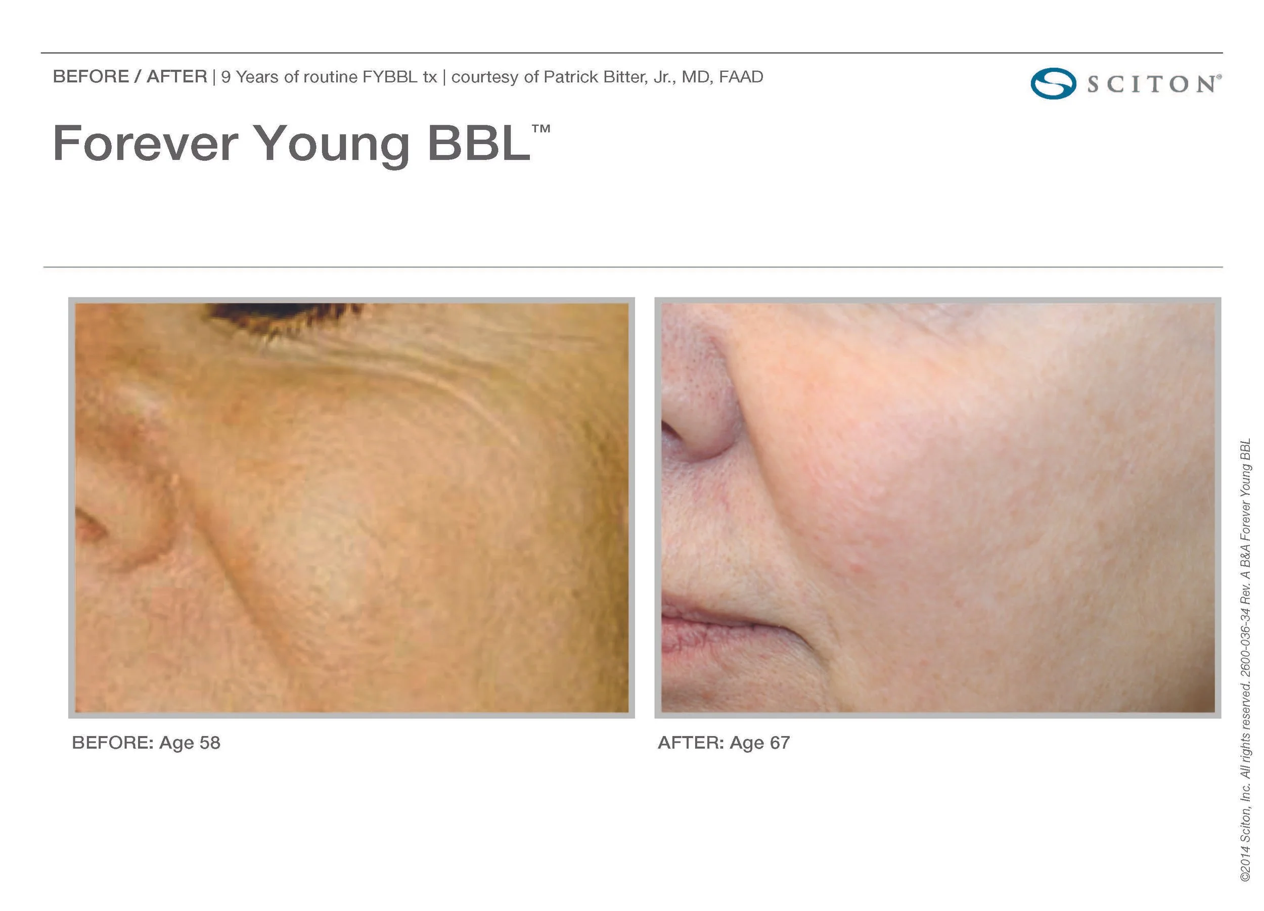 Forever Young BBL at Bloom | Reverse Visible Signs of Ageing with ...