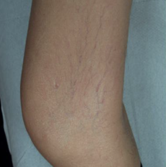 Electrolysis Swindon, Wiltshire | Treatment For Thread Veins, Skin Tags