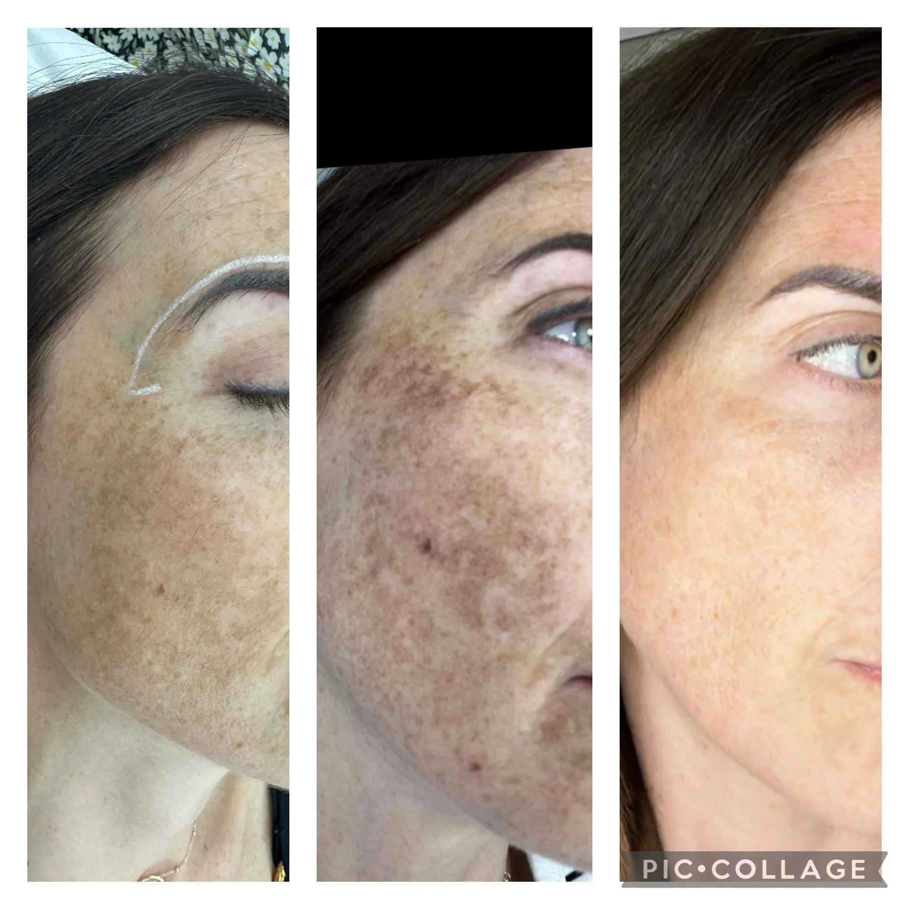 Skin Rejuvenation & Anti-Ageing Treatment Swindon Wiltshire | Pureskin