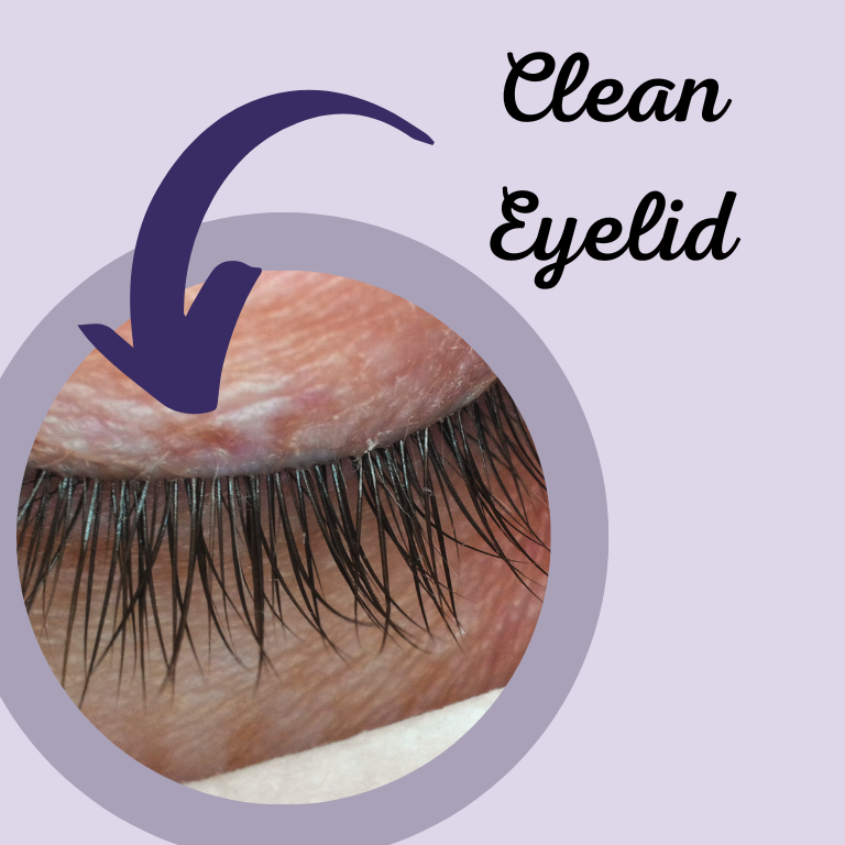 Demodex Treatment — Northeast Optometry