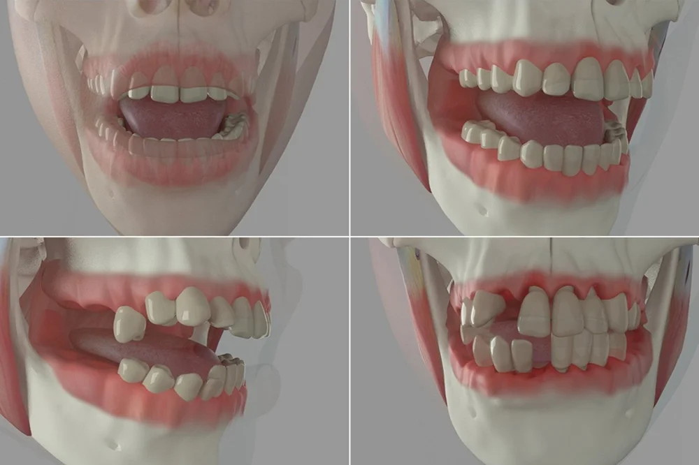 Dental 3d medical animation periodontal disease - Visualmedics Studio