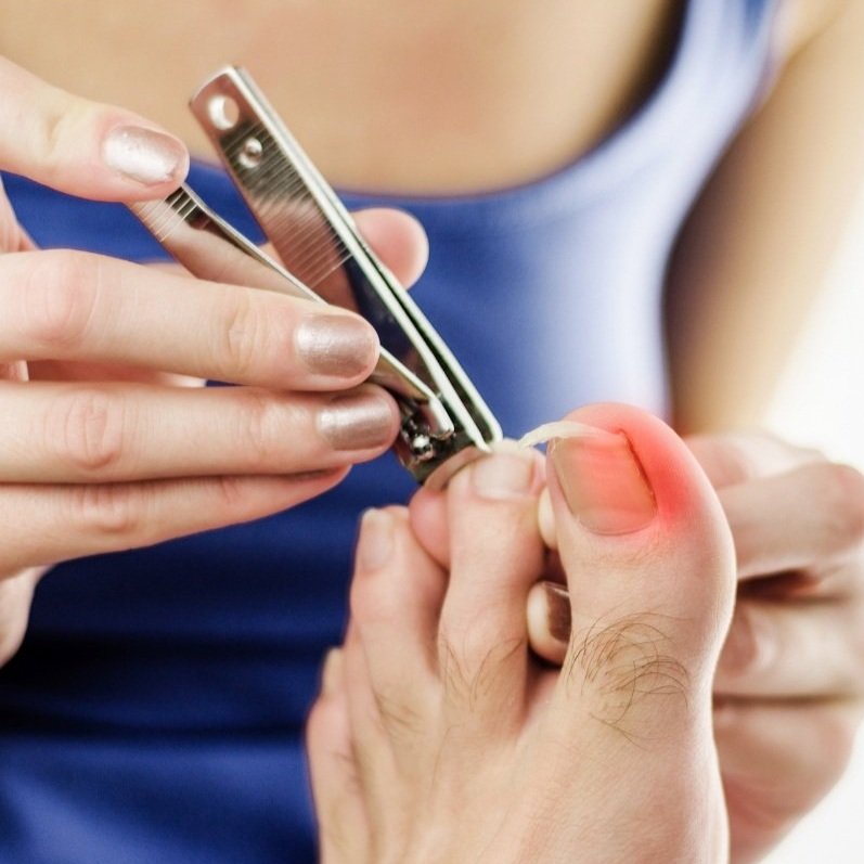 Ingrown Toenail Treatment in Powell & Dublin, OH | Performance Podiatry ...