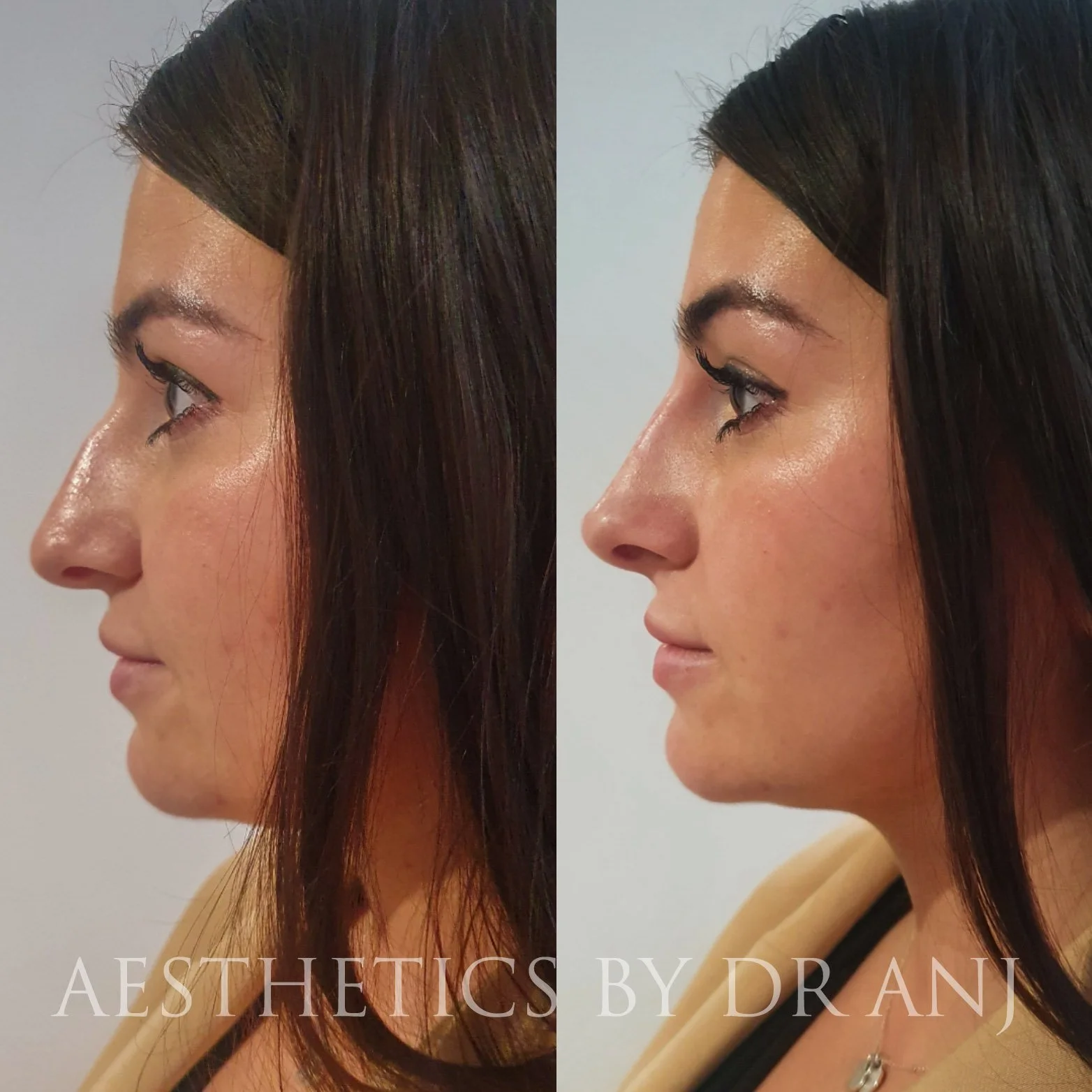 Non Surgical Rhinoplasty — Aesthetics by Dr Anj