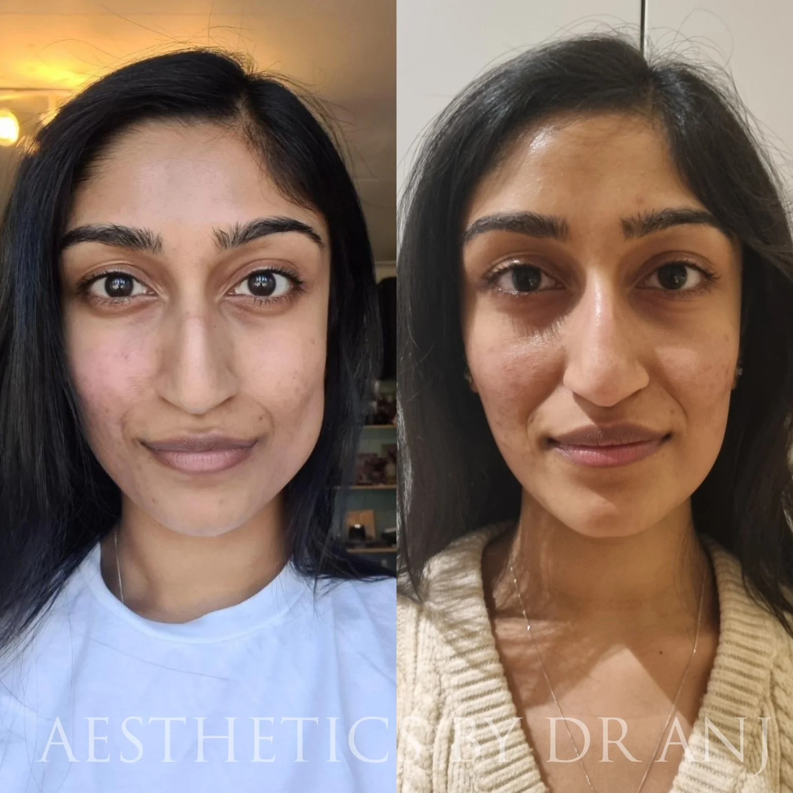 Bruxism/ Jawline Slimming — Aesthetics by Dr Anj Bruxism/ Jawline Slimming — Aesthetics by Dr Anj