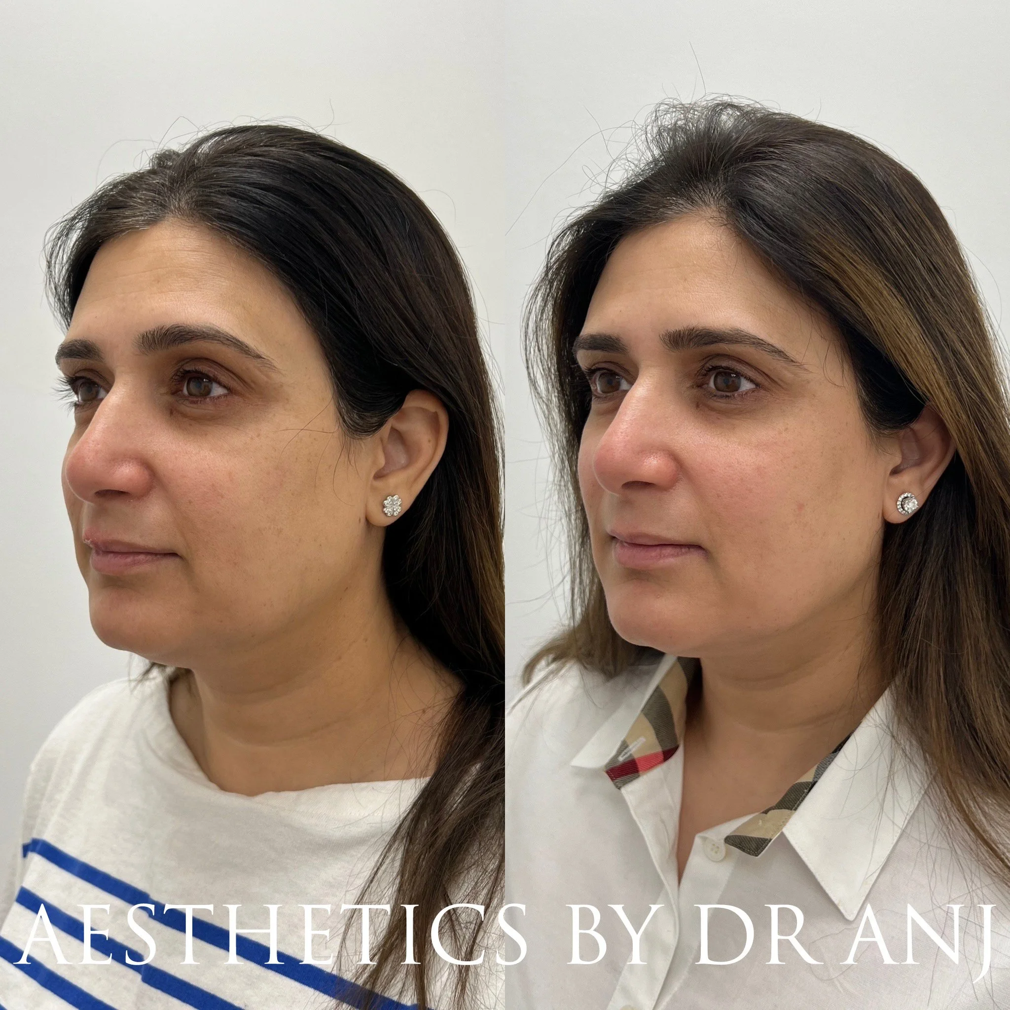 Cutis Lift — Aesthetics by Dr Anj