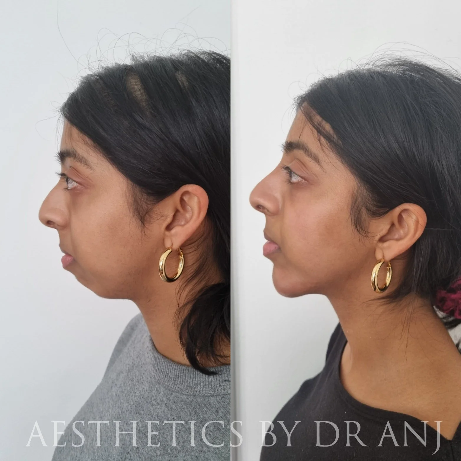 Profile Balancing — Aesthetics by Dr Anj