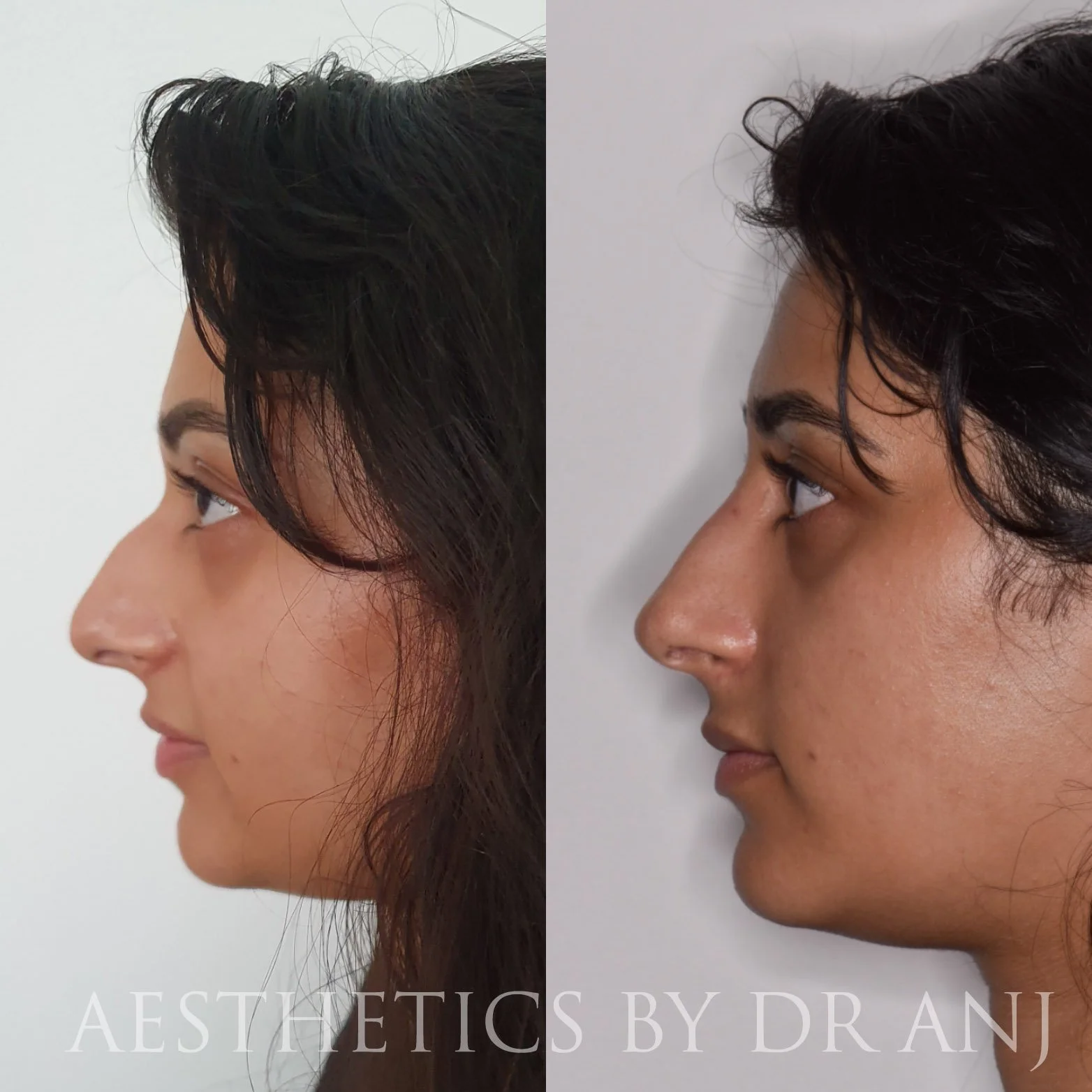 Non Surgical Rhinoplasty — Aesthetics by Dr Anj