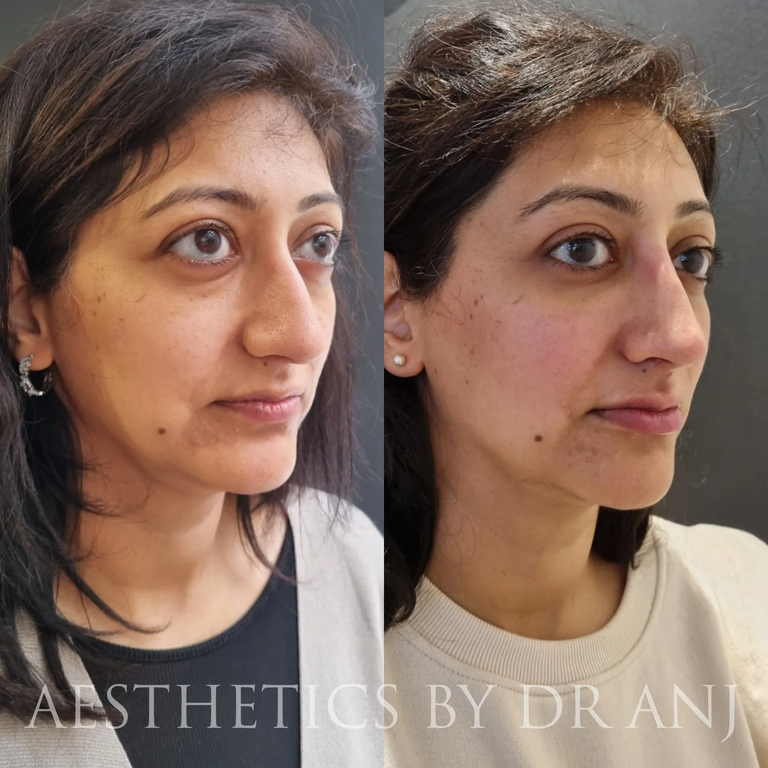 Midface — Aesthetics by Dr Anj