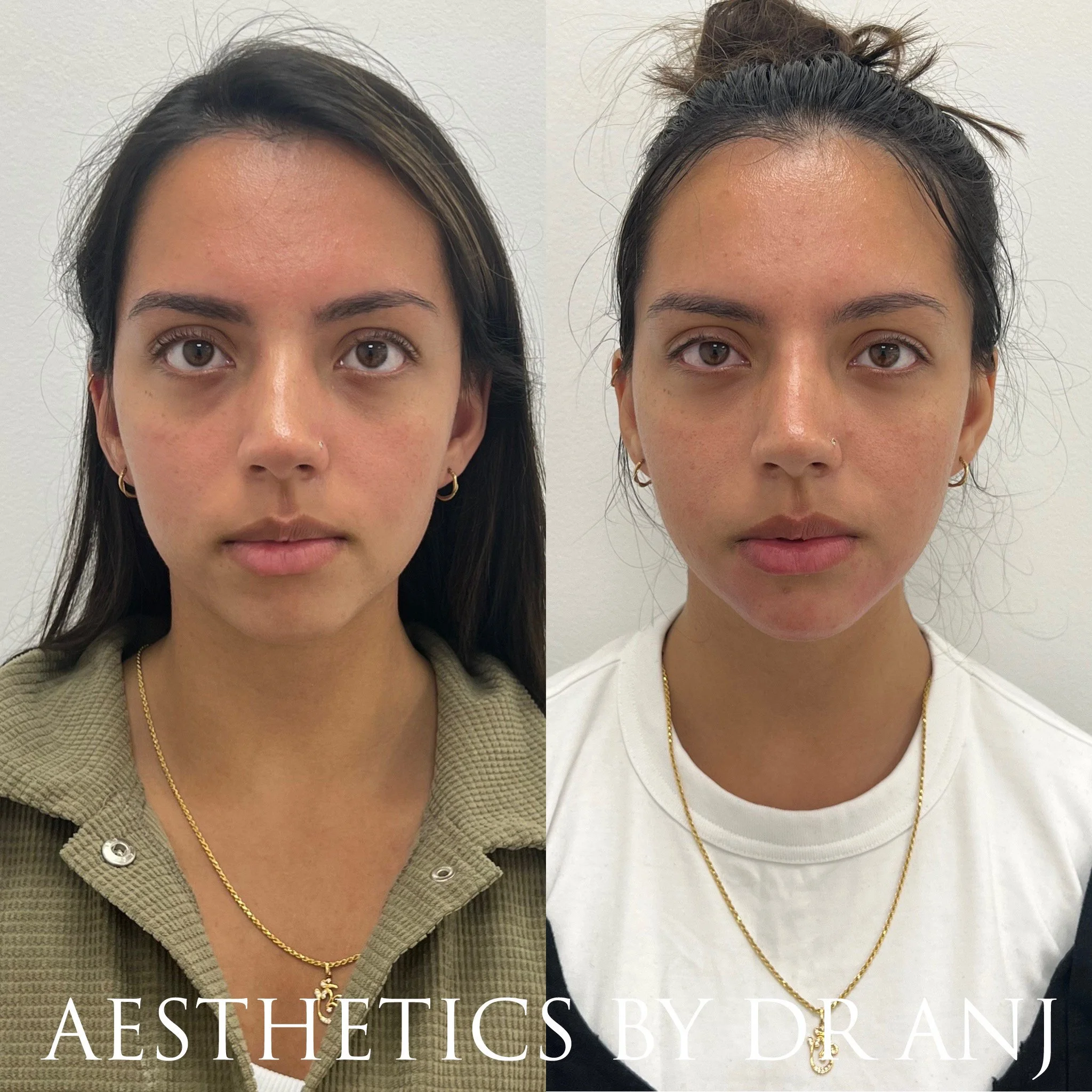 Chin Shadow — Aesthetics by Dr Anj