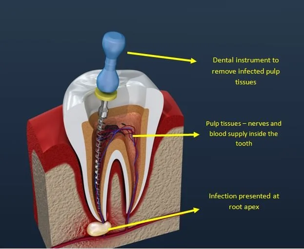 Endodontics — RC Dental Center陈蓉齿列矫正中心