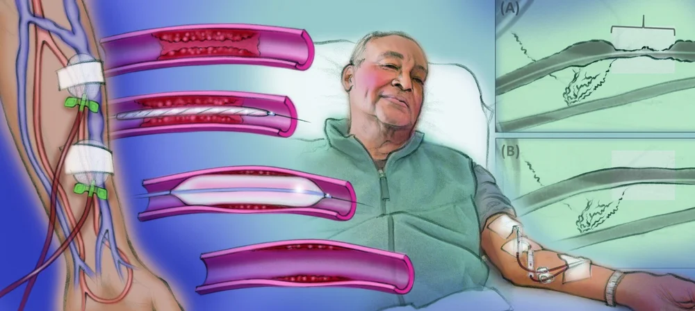 Procedure for your Dialysis Fistula or Graft — The Interventional ...