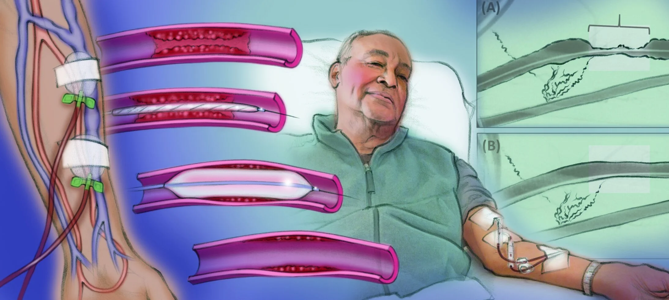 Procedure For Your Dialysis Fistula Or Graft The Interventional
