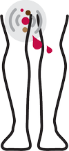 What happens after thrombolysis or thrombectomy for a DVT? — The ...