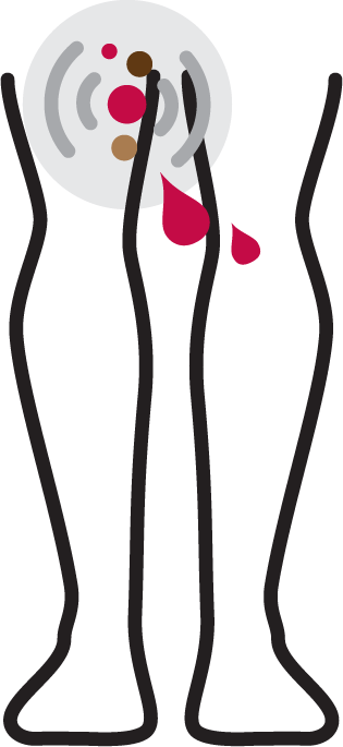 What happens after thrombolysis or thrombectomy for a DVT? — The ...