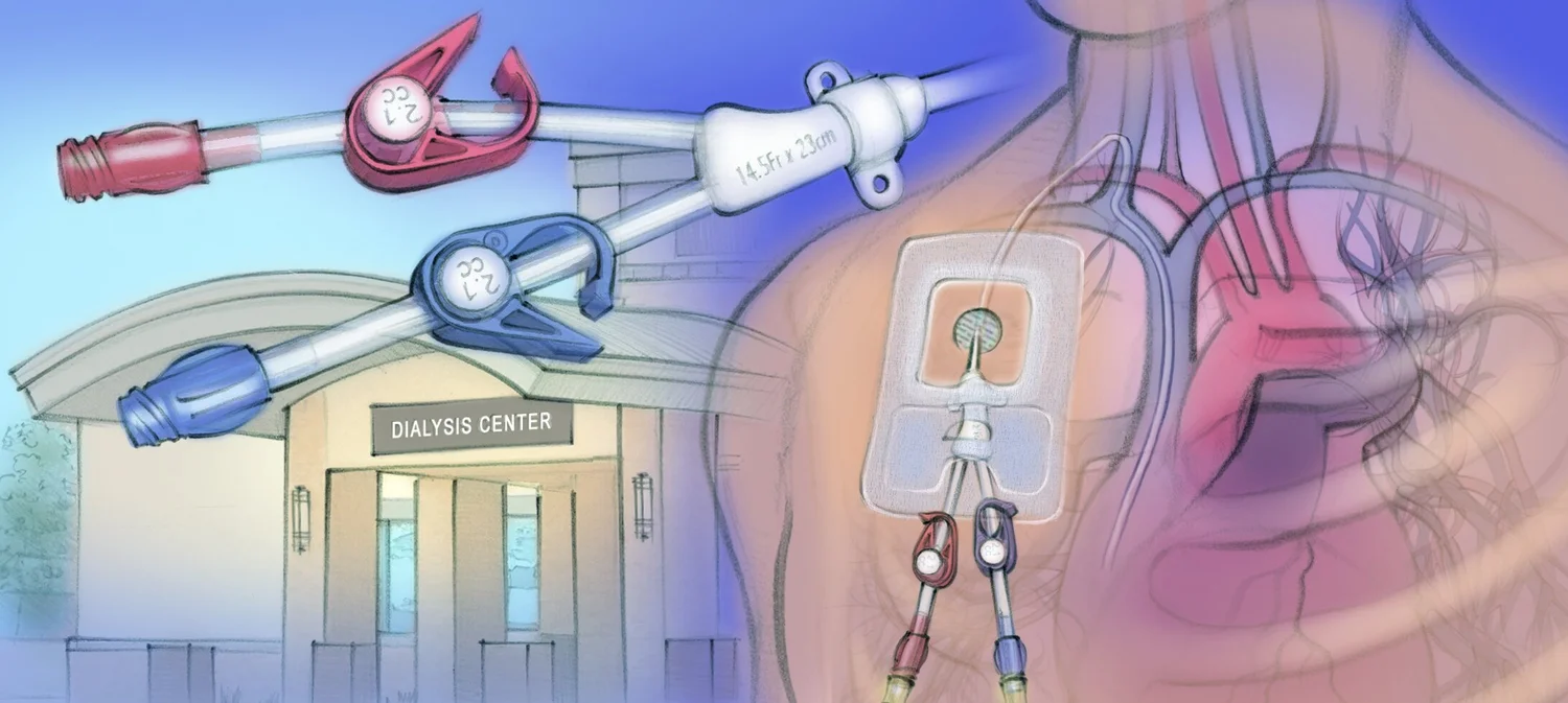 After a Hemodialysis Catheter Placement — The Interventional Initiative