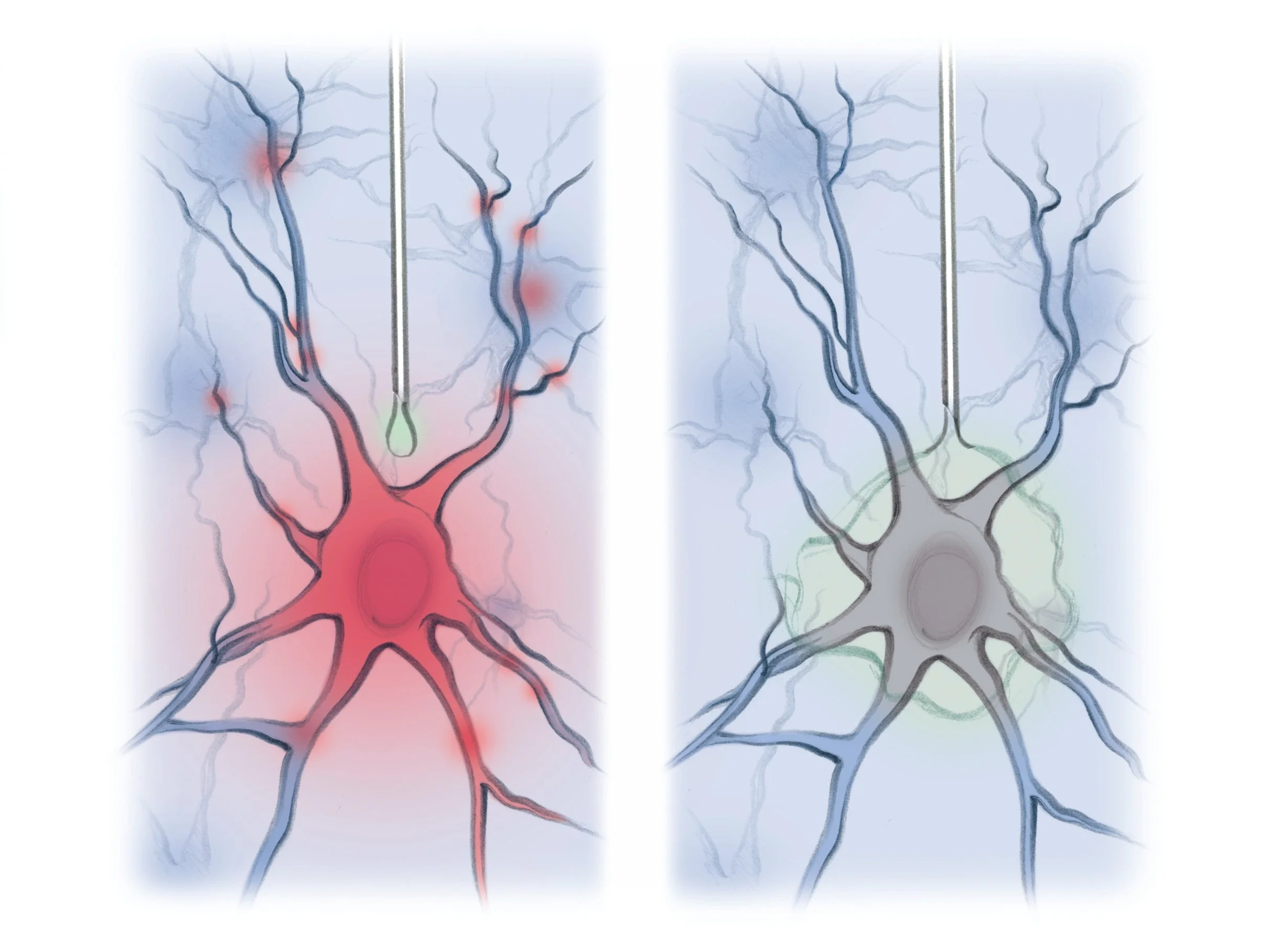Neurolisis para el control del dolor — The Interventional Initiative