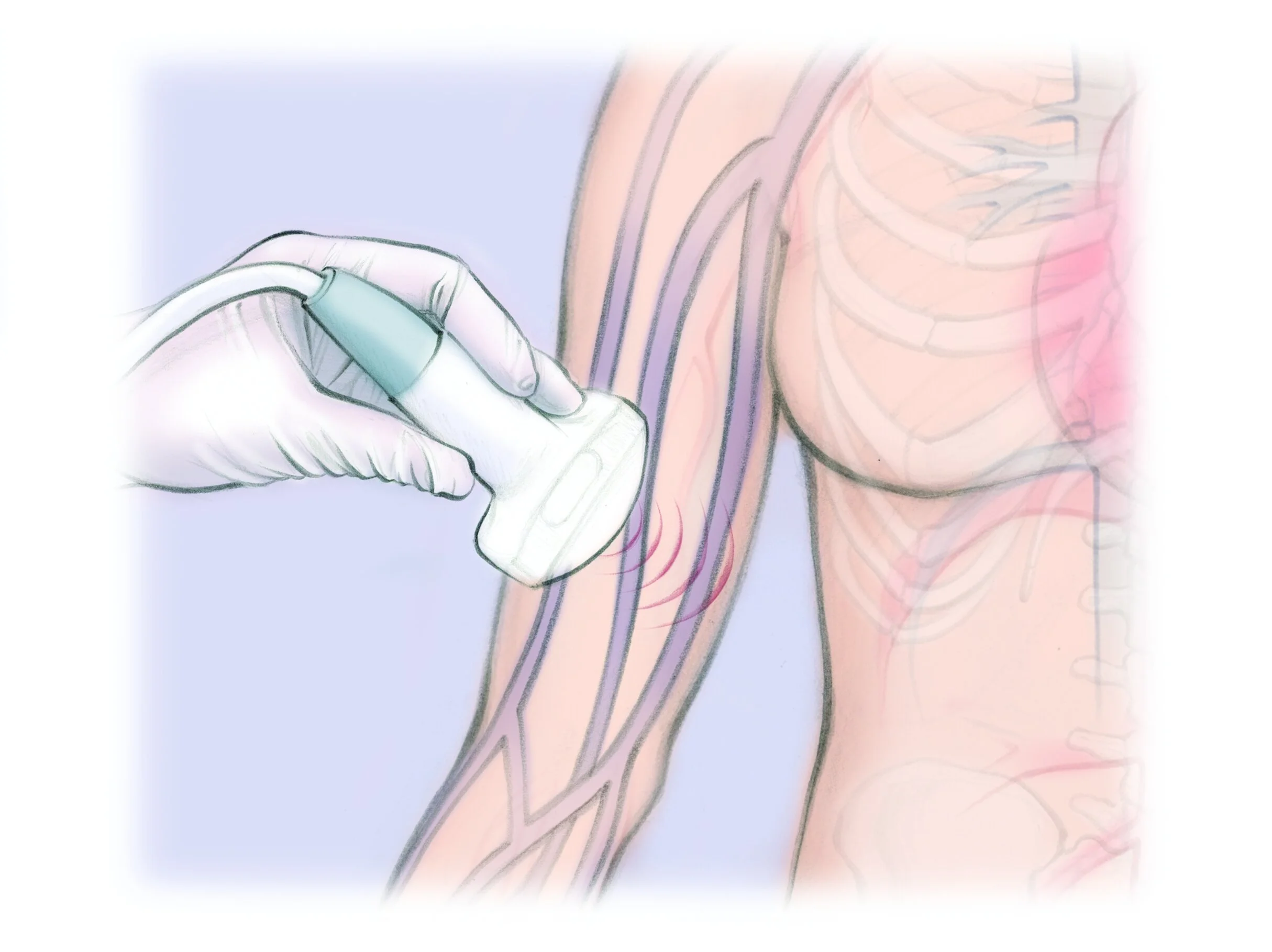 Peripherally-Inserted Central Catheter (PICC) — The Interventional Initiative