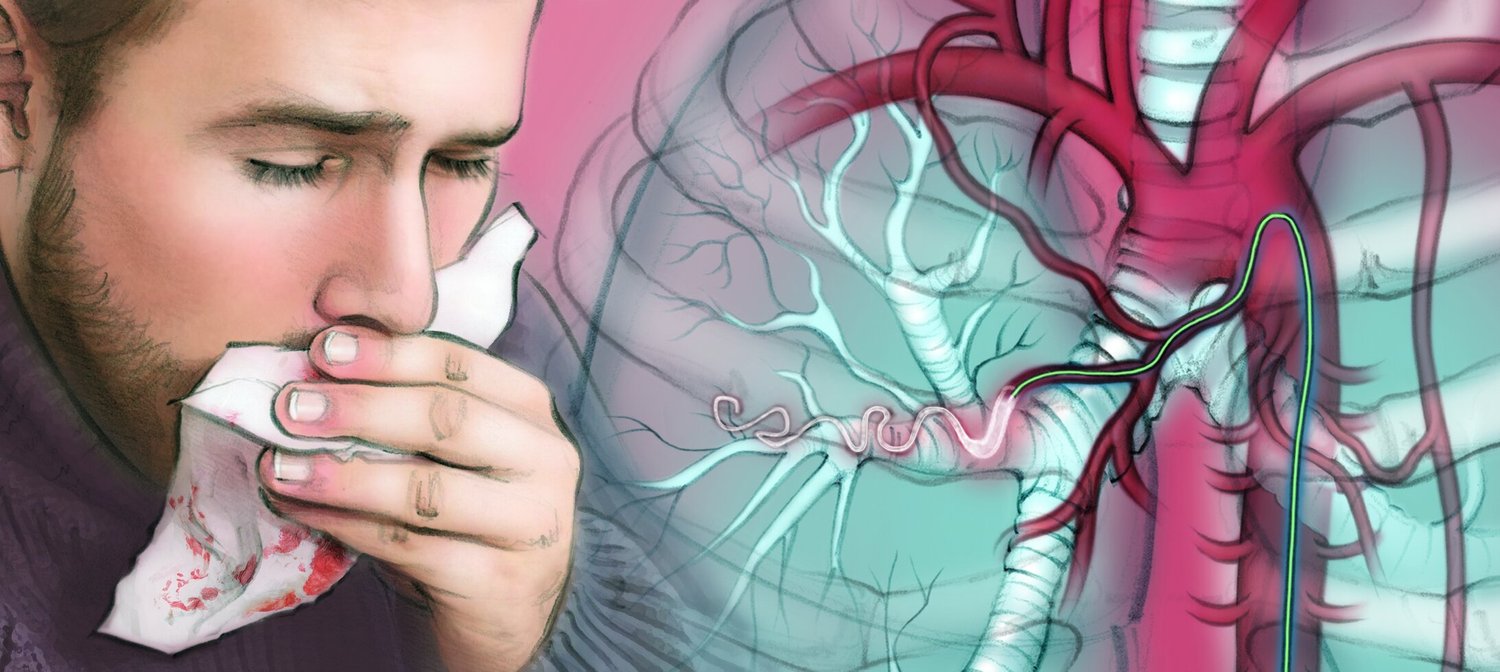 Bronchial Artery Embolization — The Interventional Initiative