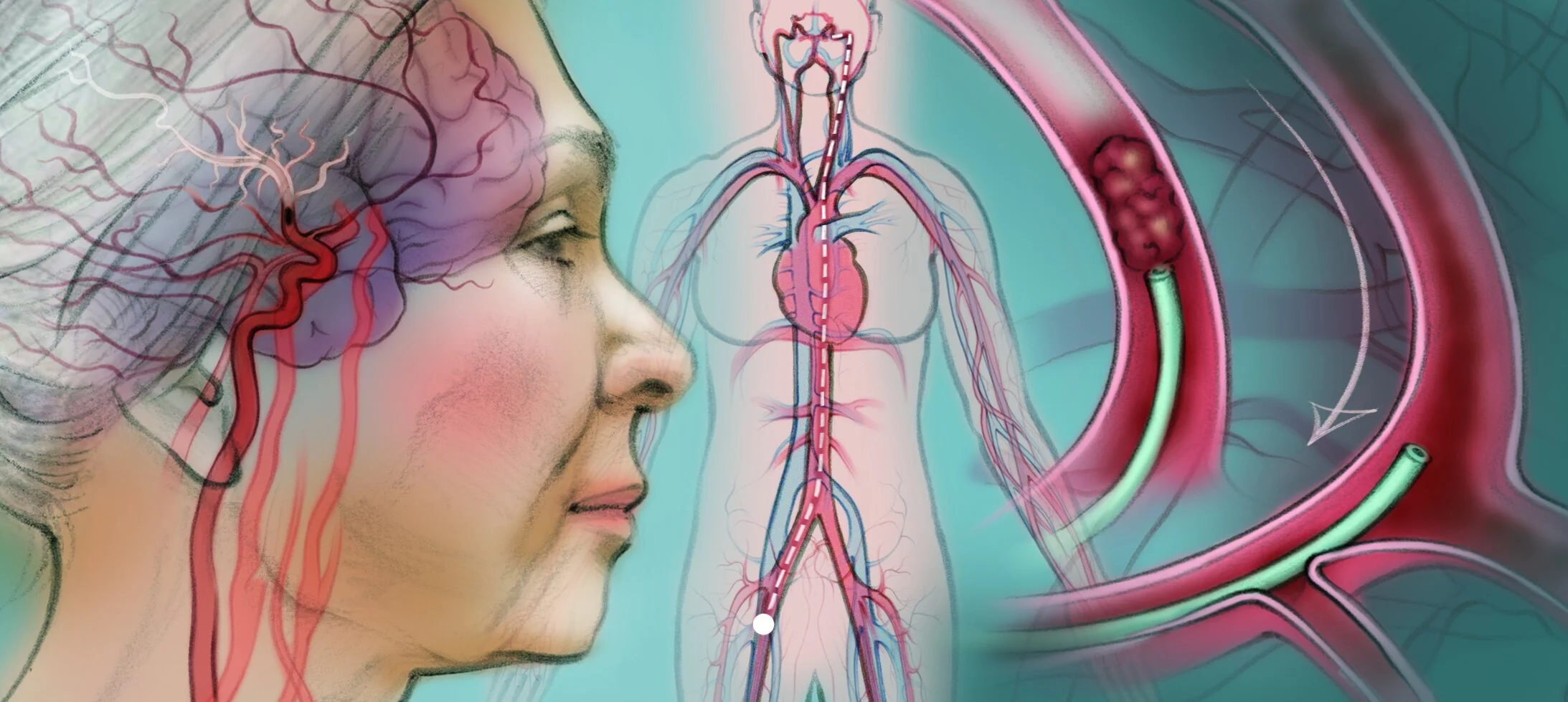 What happens after a Stroke Thrombectomy — The Interventional Initiative