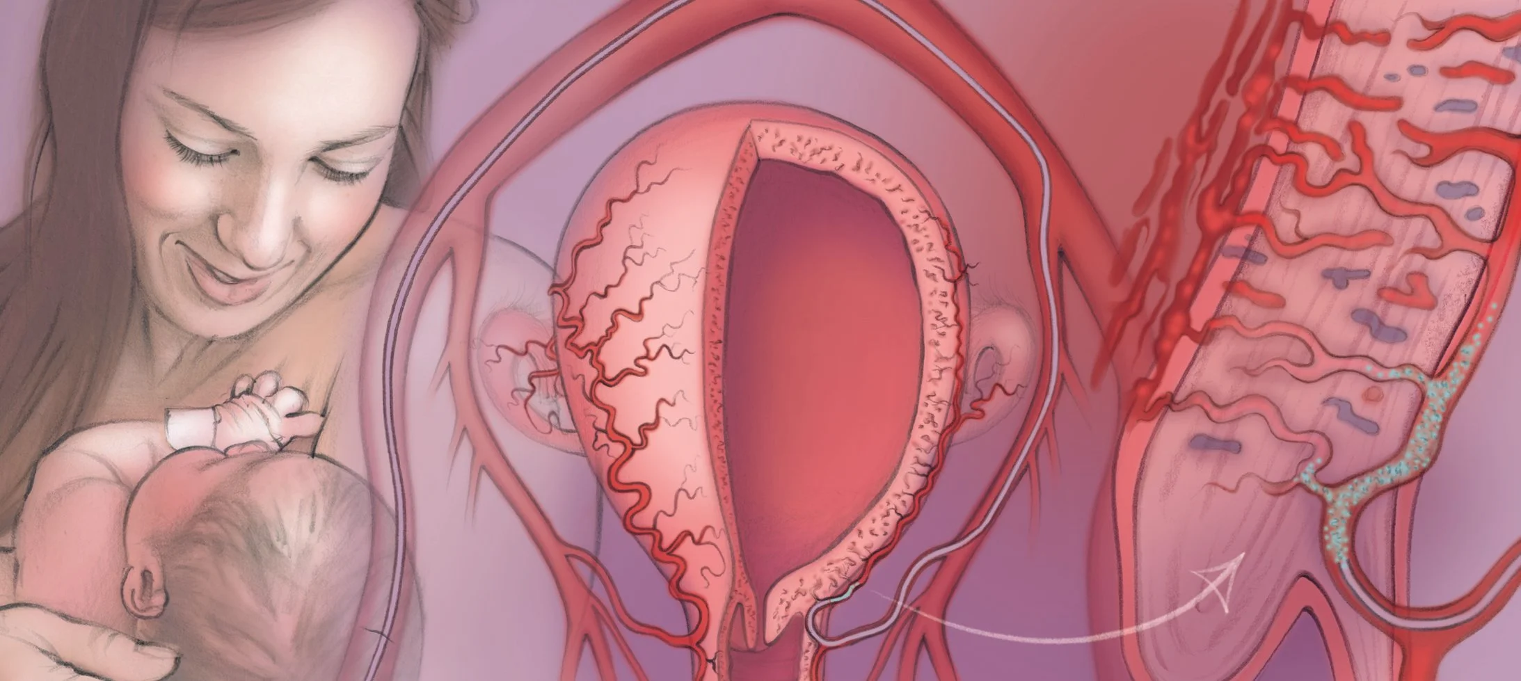 Postpartum Hemorrhage The Interventional Initiative