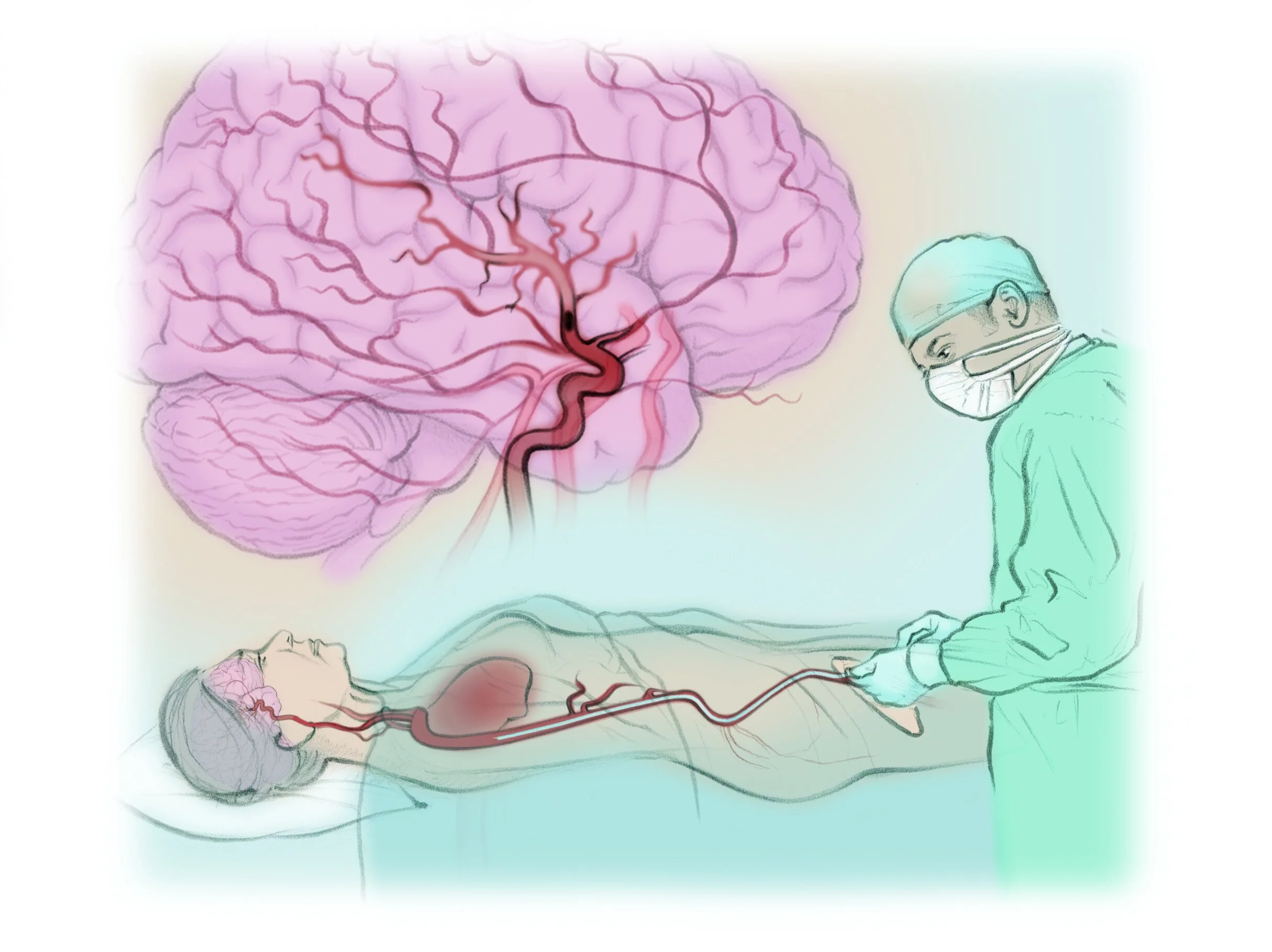 Stroke Thrombectomy — The Interventional Initiative