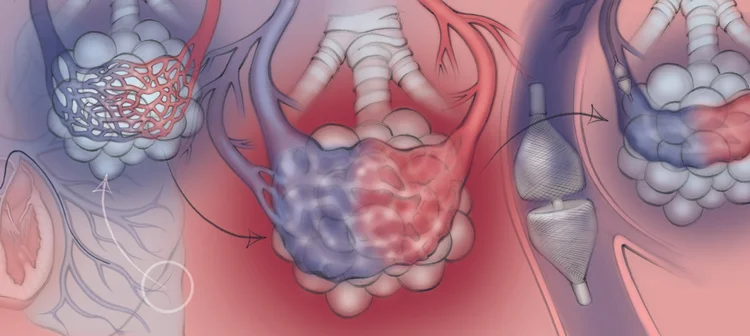 Pulmonary AVM Embolization — The Interventional Initiative