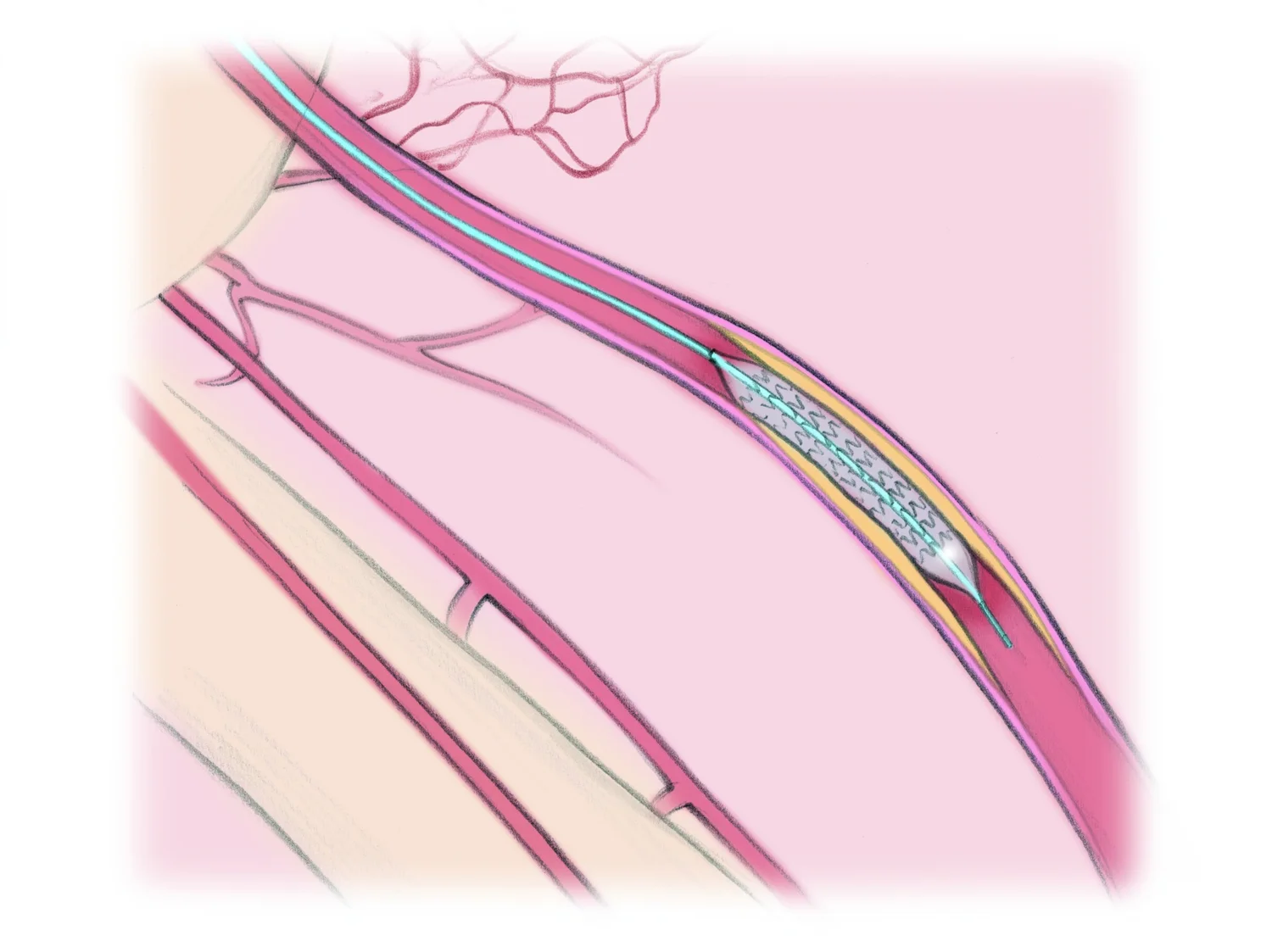 Peripheral Artery Disease — The Interventional Initiative