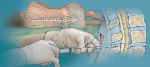 Lumbar Puncture / Myelogram — The Interventional Initiative