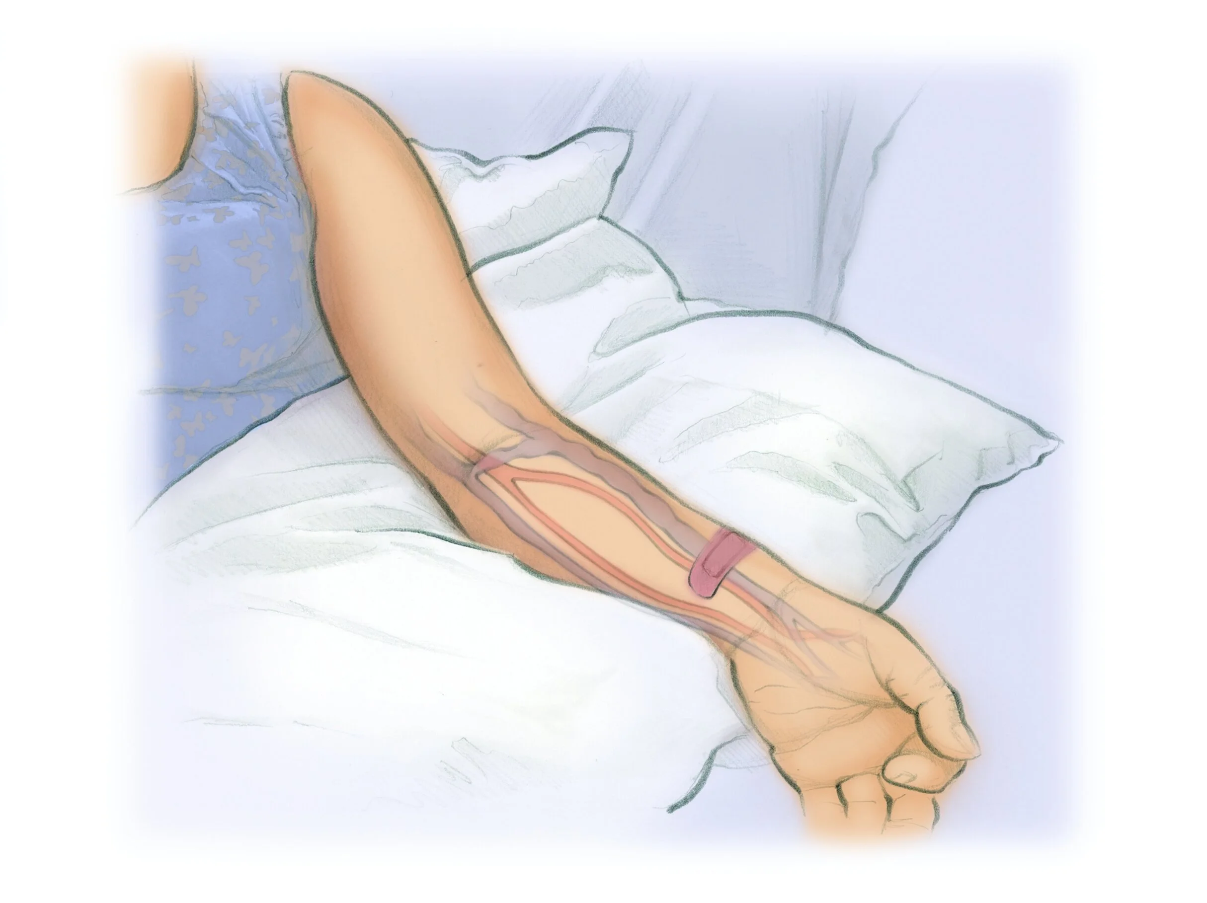 Procedure for your Dialysis Fistula or Graft — The Interventional ...