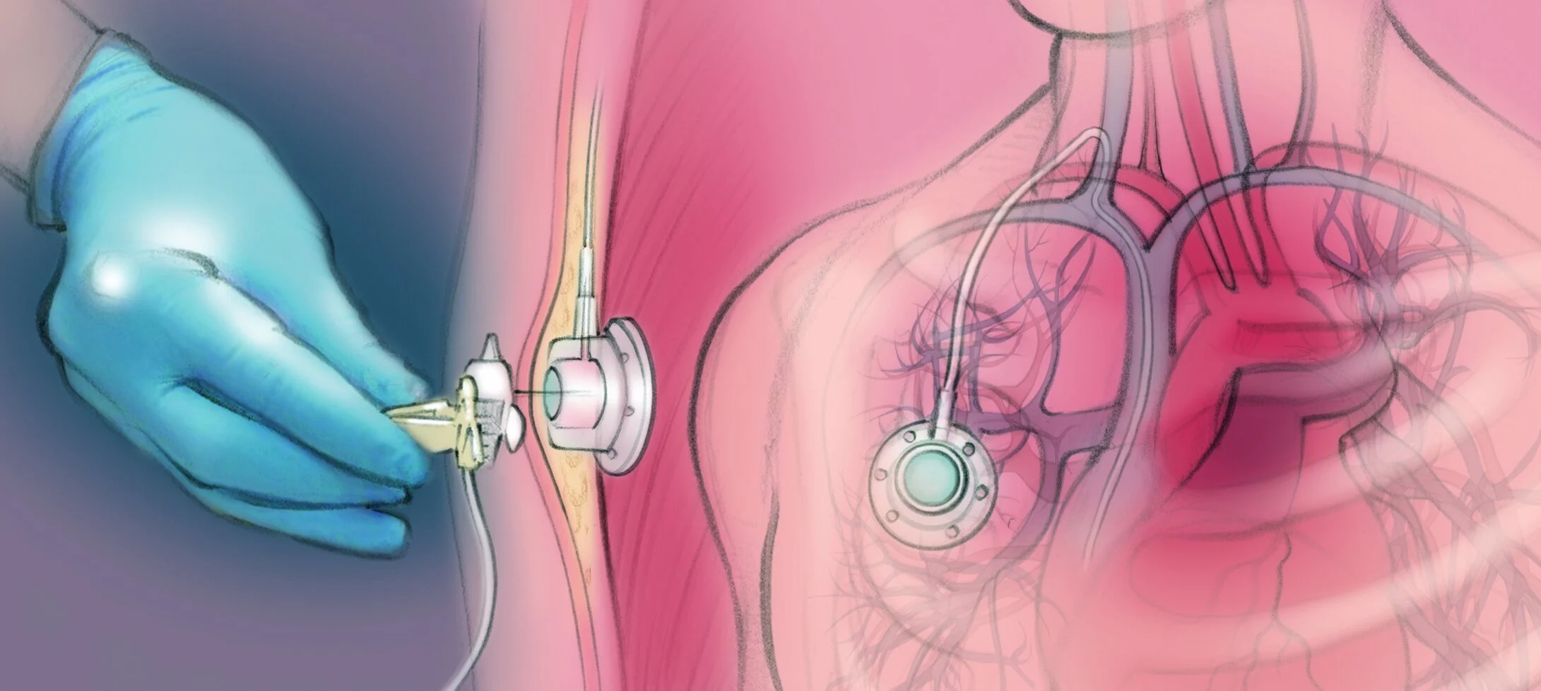 What Happens After My Port Placement The Interventional Initiative What Happens After My Port Placement The Interventional Initiative