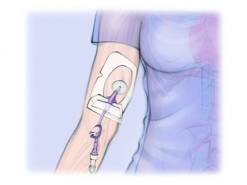 Peripherally-Inserted Central Catheter (PICC) — The Interventional ...