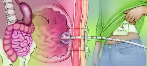 What Happens After Getting a Feeding Tube — The Interventional Initiative
