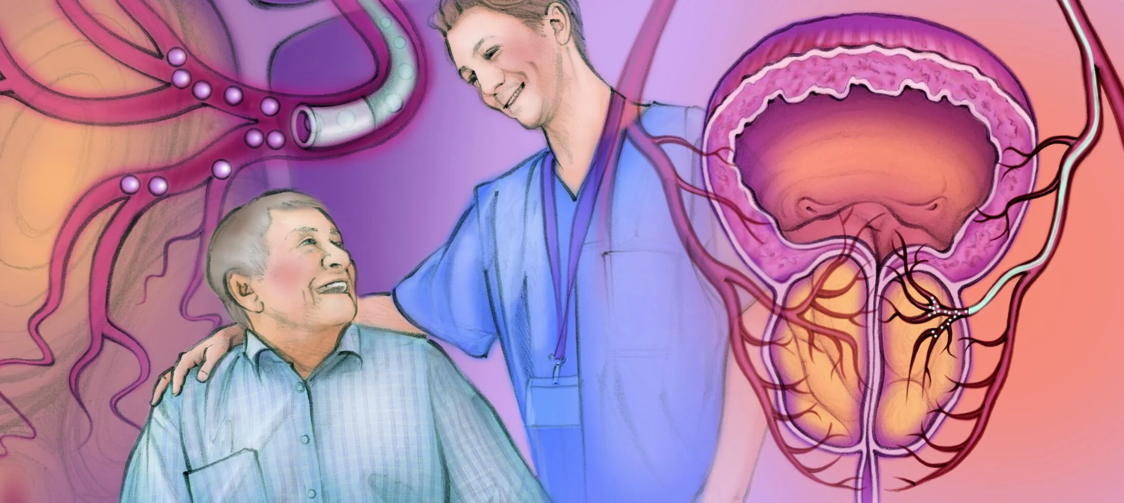 Prostate artery embolization — The Interventional Initiative