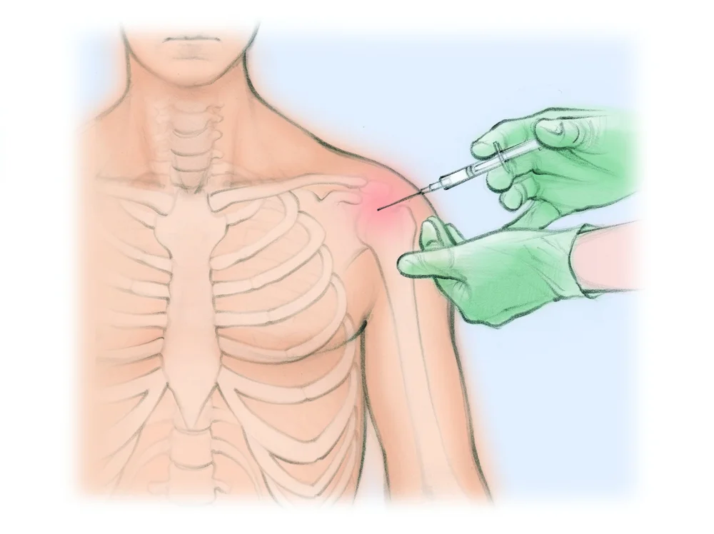 Arthrogram — The Interventional Initiative